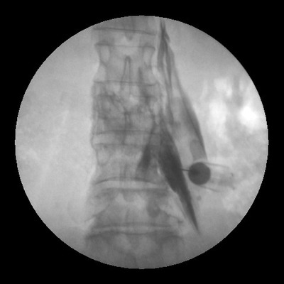 Psoas Compartment Block : 네이버 블로그