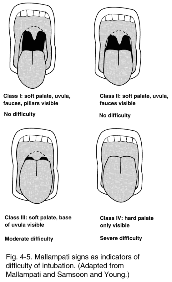 Difficult Airway Assessment - Potential Difficulty ( 어려운 기도 평가 ) : 네이버 블로그