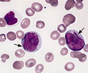 급성골수성백혈병 - Auer rods or Auer bodies : 네이버 블로그