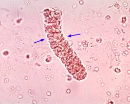 요검사(소변검사), 요침사의 현미경검사 : 네이버 블로그