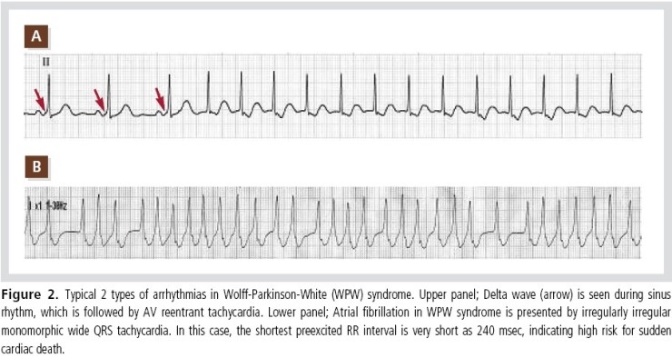 Ventricular Preexcitation Syndromes ;Wolff-Parkinson-White (WPW ...