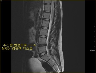 추간판 내장증 (IDD : Inernal disc disruption) : 네이버 블로그