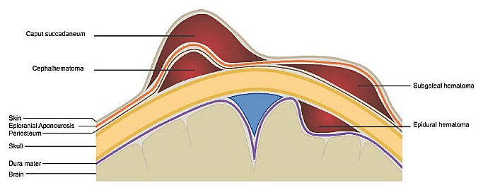 열정♡모성간호학실습지도 - [산류caput succedaneum] [두혈종cephalohematoma] : 네이버 블로그