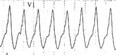 Brugada Criteria : 네이버 블로그