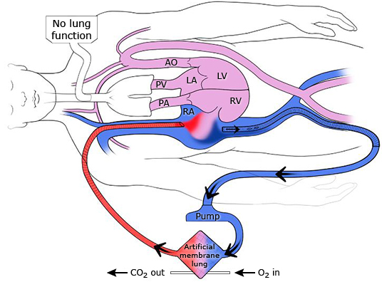 에크모(ECMO) : 네이버 블로그
