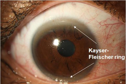 Wilson disease(윌슨병) : 네이버 블로그