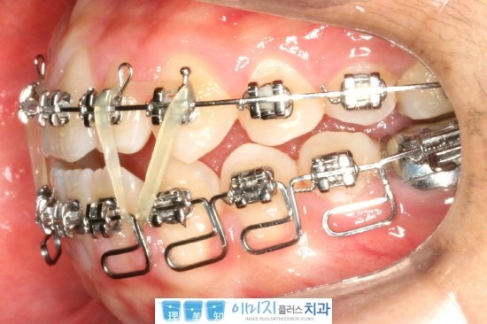 개방교합, III 급 부정교합 치료에 효과적인 MEAW 장치 [서면치아교정] : 네이버 블로그