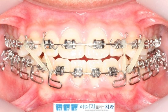 개방교합, III 급 부정교합 치료에 효과적인 MEAW 장치 [서면치아교정] : 네이버 블로그