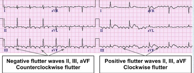 Atrial Flutter (AFL = 심방조동) : 네이버 블로그