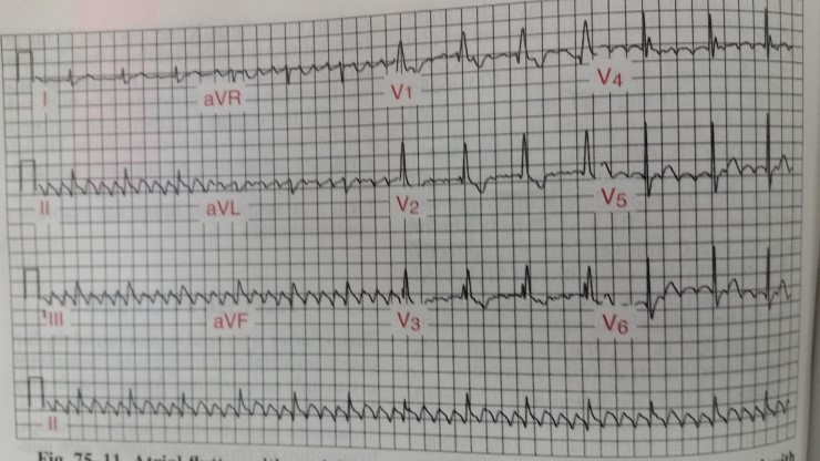 Atrial Flutter (AFL = 심방조동) : 네이버 블로그