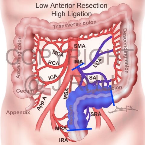 메디컬일러스트 그리닥 : 대장절제술 (결장절제술, colon resection) 의 종류들 : 네이버 블로그