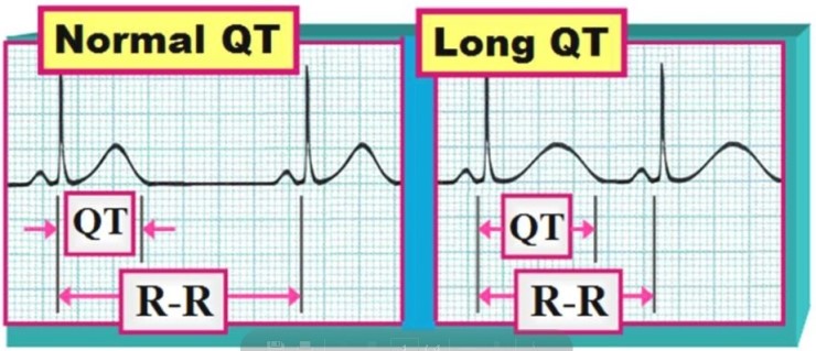 QT prolongation / QT prolongation syndrome(QT연장증후군) : 네이버 블로그