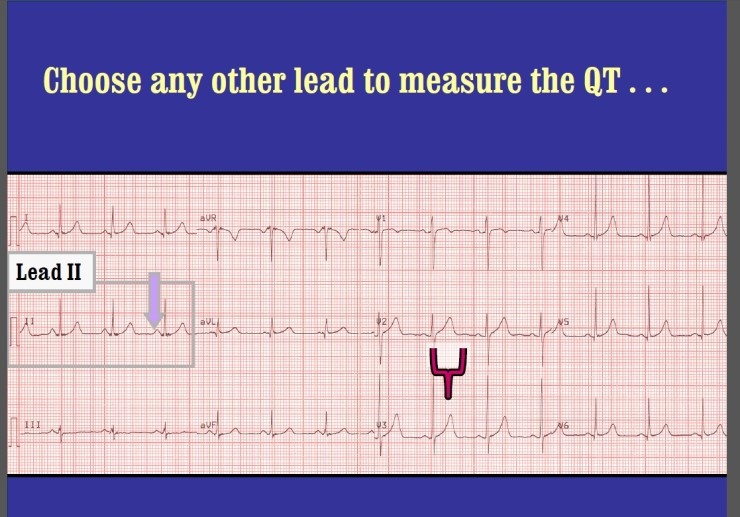 QT prolongation / QT prolongation syndrome(QT연장증후군) : 네이버 블로그