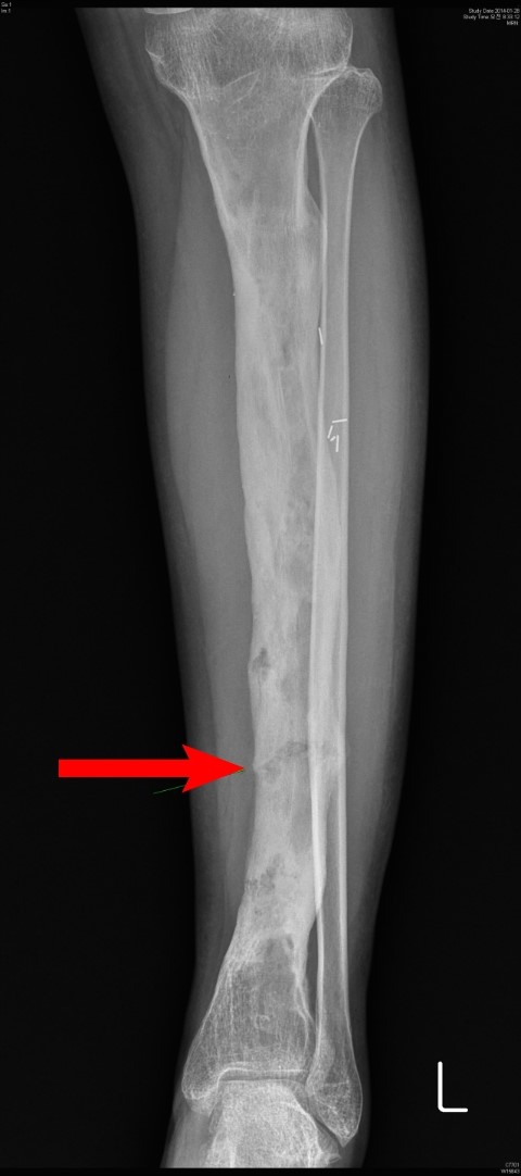 새로운 CAST 의 탄생! PTB Delbet Gaiter Cast !! : 네이버 블로그