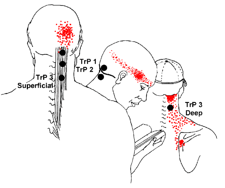Semispinalis : 반극근 : 네이버 블로그