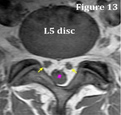 [척추] 해부학 : 척수(Spinal Cord) 및 척추신경(Spinal Nerve) & Branch : 네이버 블로그