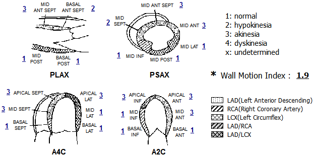 proximal LAD infarction : 네이버 블로그