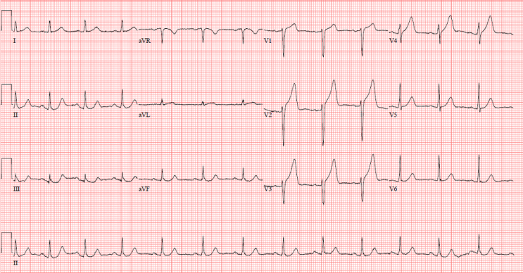 LAD territory infarction : 네이버 블로그