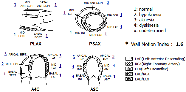 LAD territory infarction : 네이버 블로그