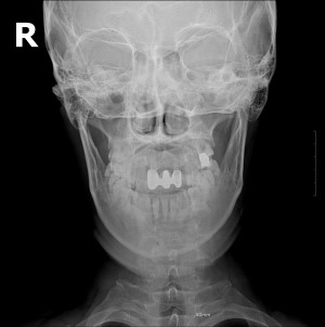 skull & facial 방사선촬영법 / 방사선검사메뉴얼 : 네이버 블로그