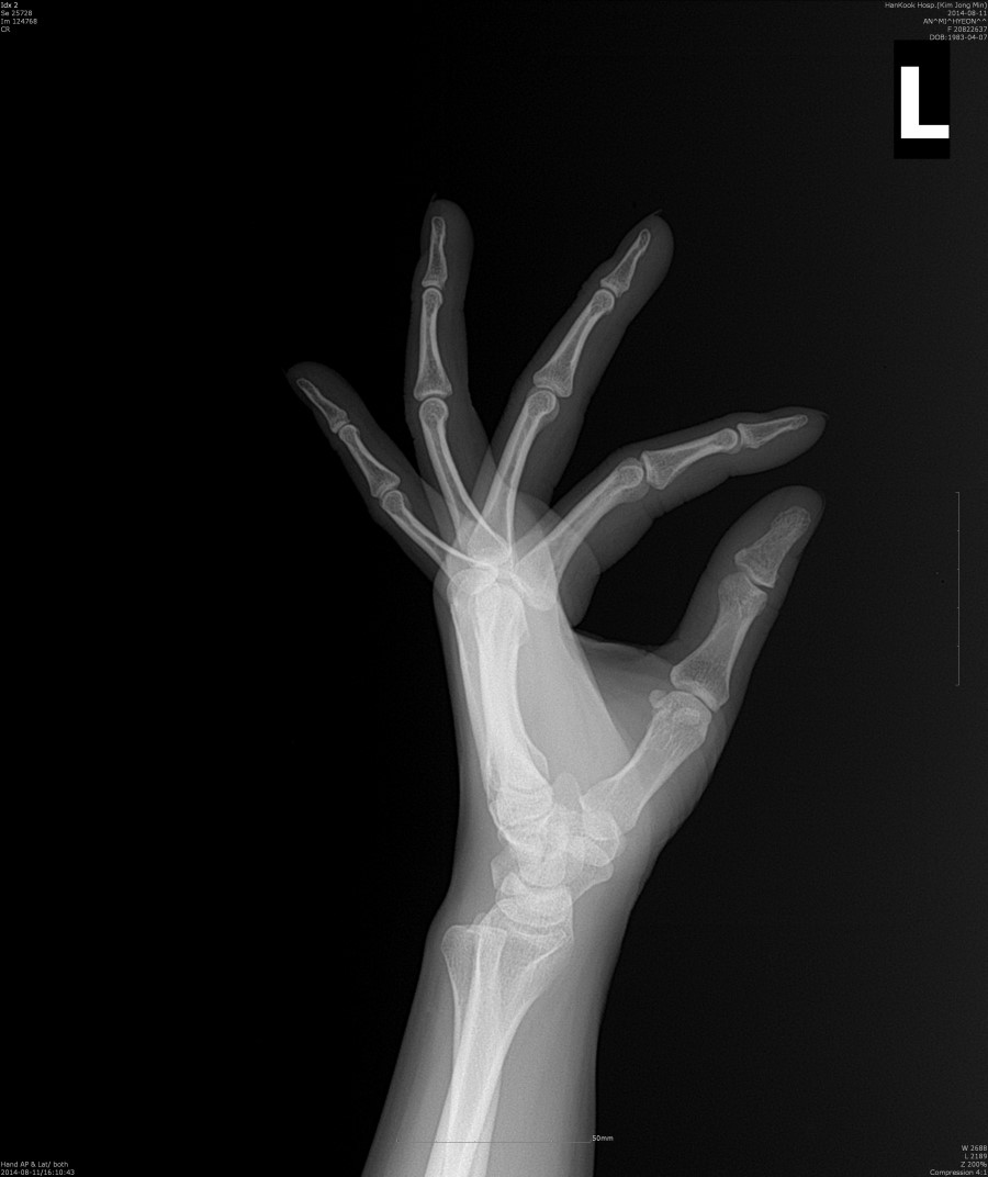 Upper extermity 방사선검사메뉴얼 : 네이버 블로그