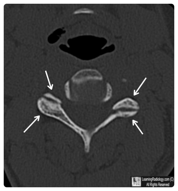 [영상의학] 척추 외상의 단순 X-ray 진단 : 네이버 블로그
