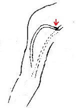자쪽 피부정맥 전위술(basilic vein transposition)을 이용한 동정맥루 : 네이버 블로그