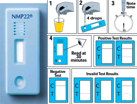 방광암 선별검사, NMP22 정성 및 정량검사 : 네이버 블로그