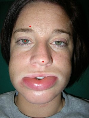 혈관부종( Angioedema)은 갑경축체질병 목음>금음>기타 : 네이버 블로그