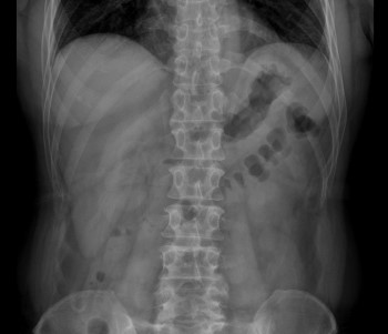 폴립절제 후 응고증후군, Postpolypectomy coagulation syndrome : 네이버 블로그