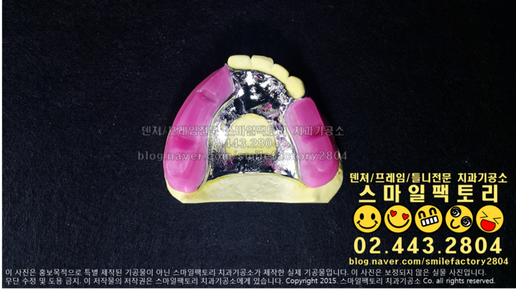 wax rim까지 완성된 AP bar타입 프레임입니다~!덴쳐(Denture)프레임(Frame)파샬(Partial)틀니전문기공소 ...