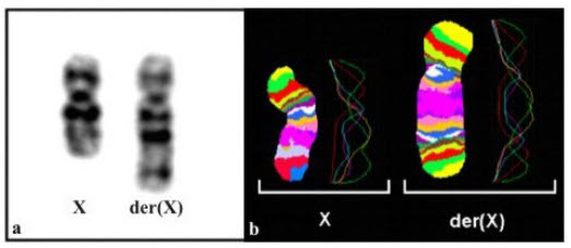 가성 동종 이중심절 X염색체, psu idic(X) : 네이버 블로그