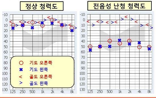 스타키보청기 성남수정센터 난청의 유형 전음성 난청 감각신경성 난청 혼합성 난청 네이버 블로그