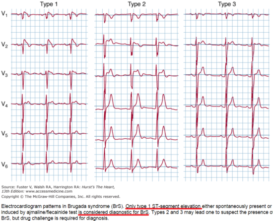 브루가다 (Brugada type 3) 의증 심전도 사례 : 네이버 블로그