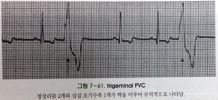 EKG 판독 : 네이버 블로그