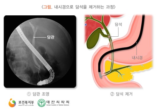 내시경적 검사치료 정리(ERCP, EST, ENBD, ERBD, PTBD) : 네이버 블로그