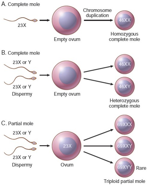gestational trophoblastic disease(임신융모질환)- hydatidiform mole ...