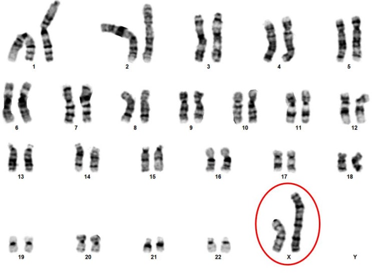 가성 동종 이중심절 X염색체, psu idic(X) : 네이버 블로그