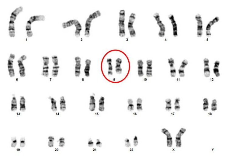 9번 염색체의 협동원체 역위 inv(9)(p11q13) : 네이버 블로그