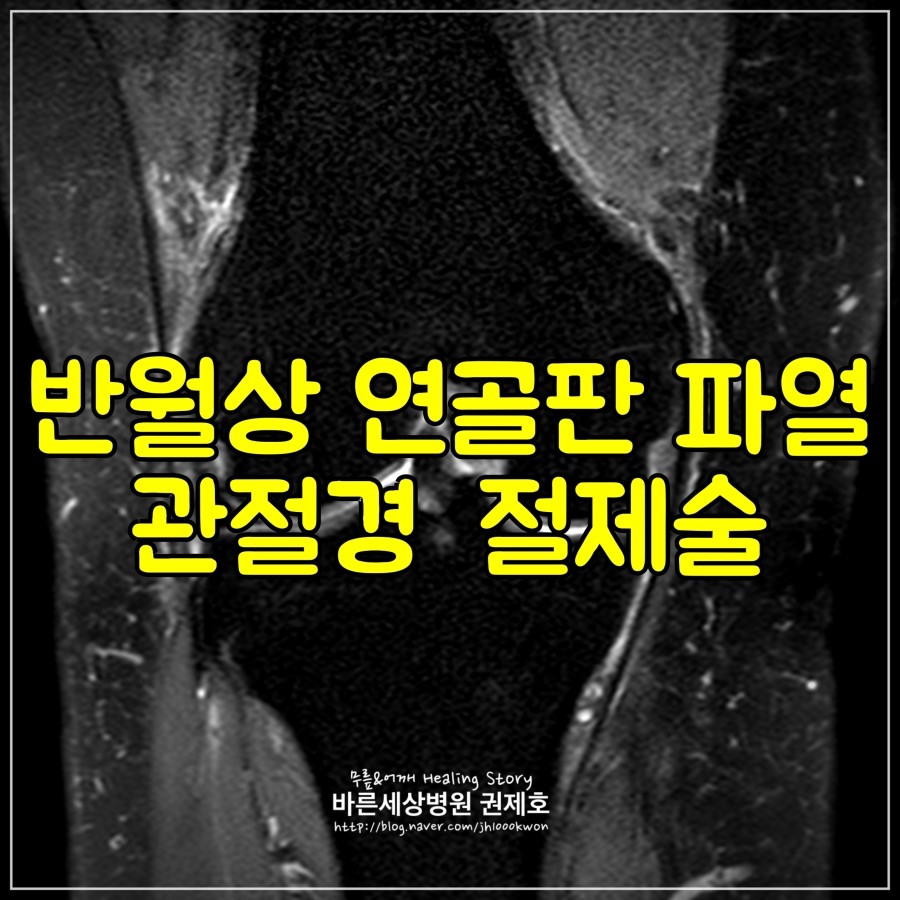 무릎연골판파열 관절경절제술 가장 흔한 정형외과 무릎수술 네이버 블로그