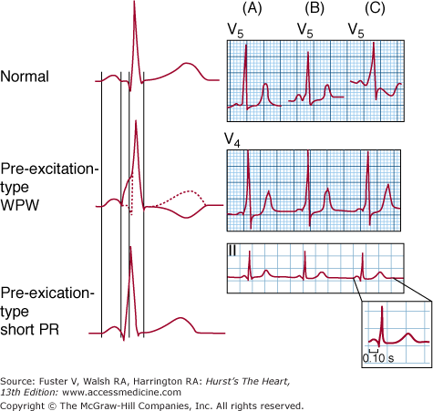 검진으로 내원하여 고혈압과 WPW (Wolff-Parkinson-White) pattern의 심전도 소견을 보인 사례 : 네이버 블로그