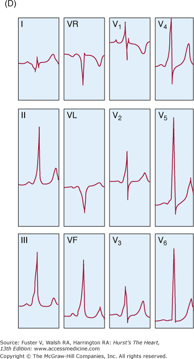 검진으로 내원하여 고혈압과 WPW (Wolff-Parkinson-White) pattern의 심전도 소견을 보인 사례 : 네이버 블로그