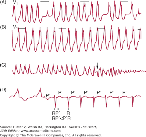 검진으로 내원하여 고혈압과 WPW (Wolff-Parkinson-White) pattern의 심전도 소견을 보인 사례 : 네이버 블로그