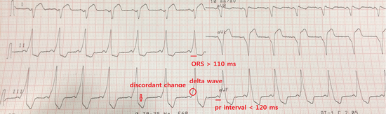 검진으로 내원하여 고혈압과 WPW (Wolff-Parkinson-White) pattern의 심전도 소견을 보인 사례 : 네이버 블로그
