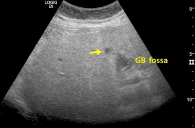 미만성 간질환의 초음파 소견 I. 지방간 : 네이버 블로그