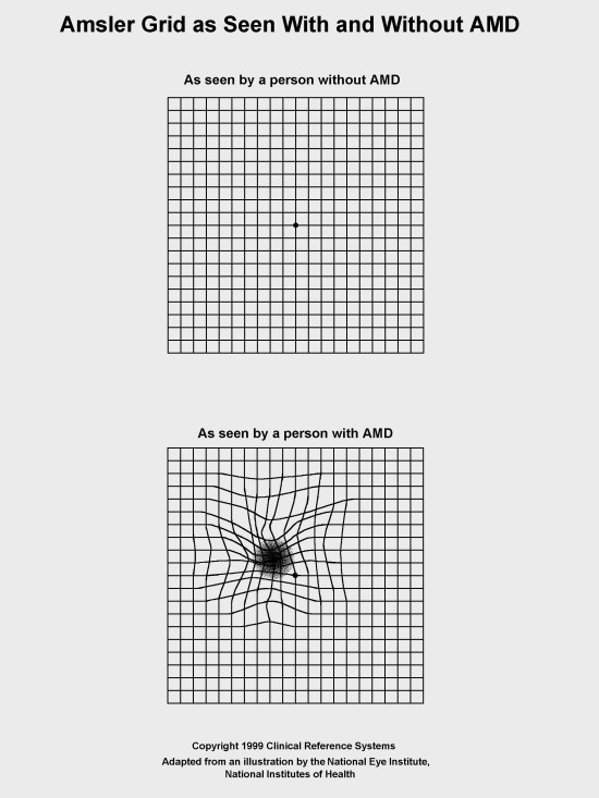 암슬러 격자 검사(Amsler grid test)/ 망막 황반변성 및 암점 검사 : 네이버 블로그