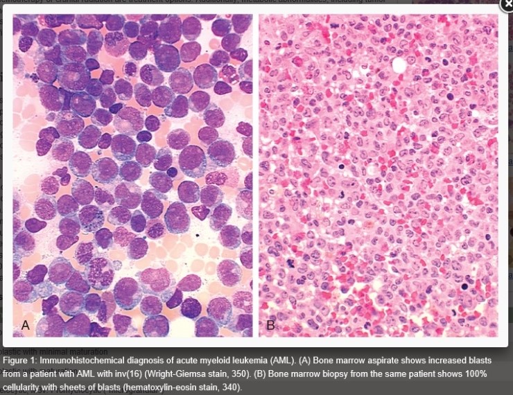 acute myelogenous leukemia (AML) : 네이버 블로그