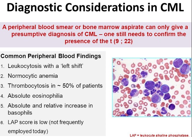 chronic myelogenous leukemia (CML, 만성골수세포백혈병) : 네이버 블로그