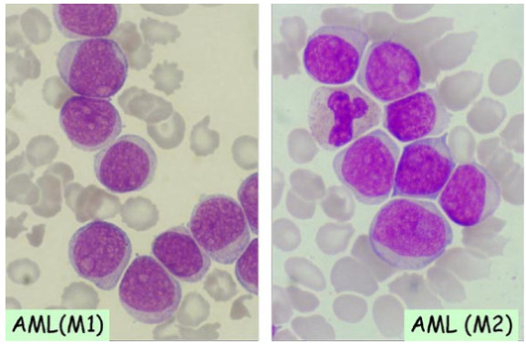 acute myelogenous leukemia (AML) : 네이버 블로그