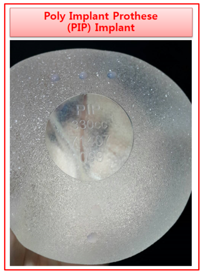 Poly Implant Prothese 보형물 (PIP implant, France) : 네이버 블로그